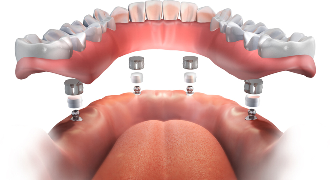 All on 4 in Albania: Affordable Dental Implants in Tirana