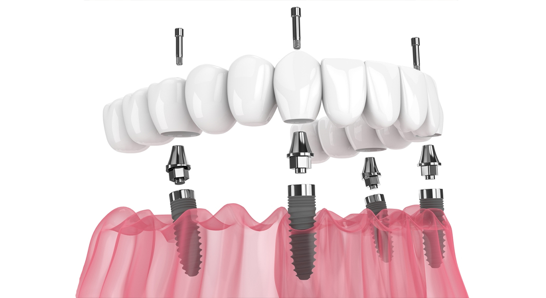 All on 4 in Albania: Affordable Dental Implants in Tirana