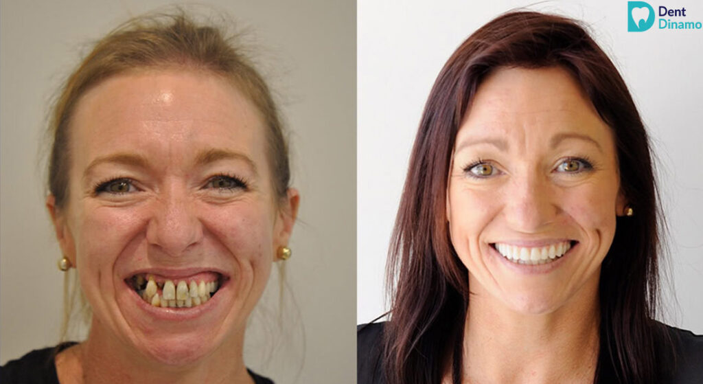 All on 4 in Albania: Affordable Dental Implants in Tirana